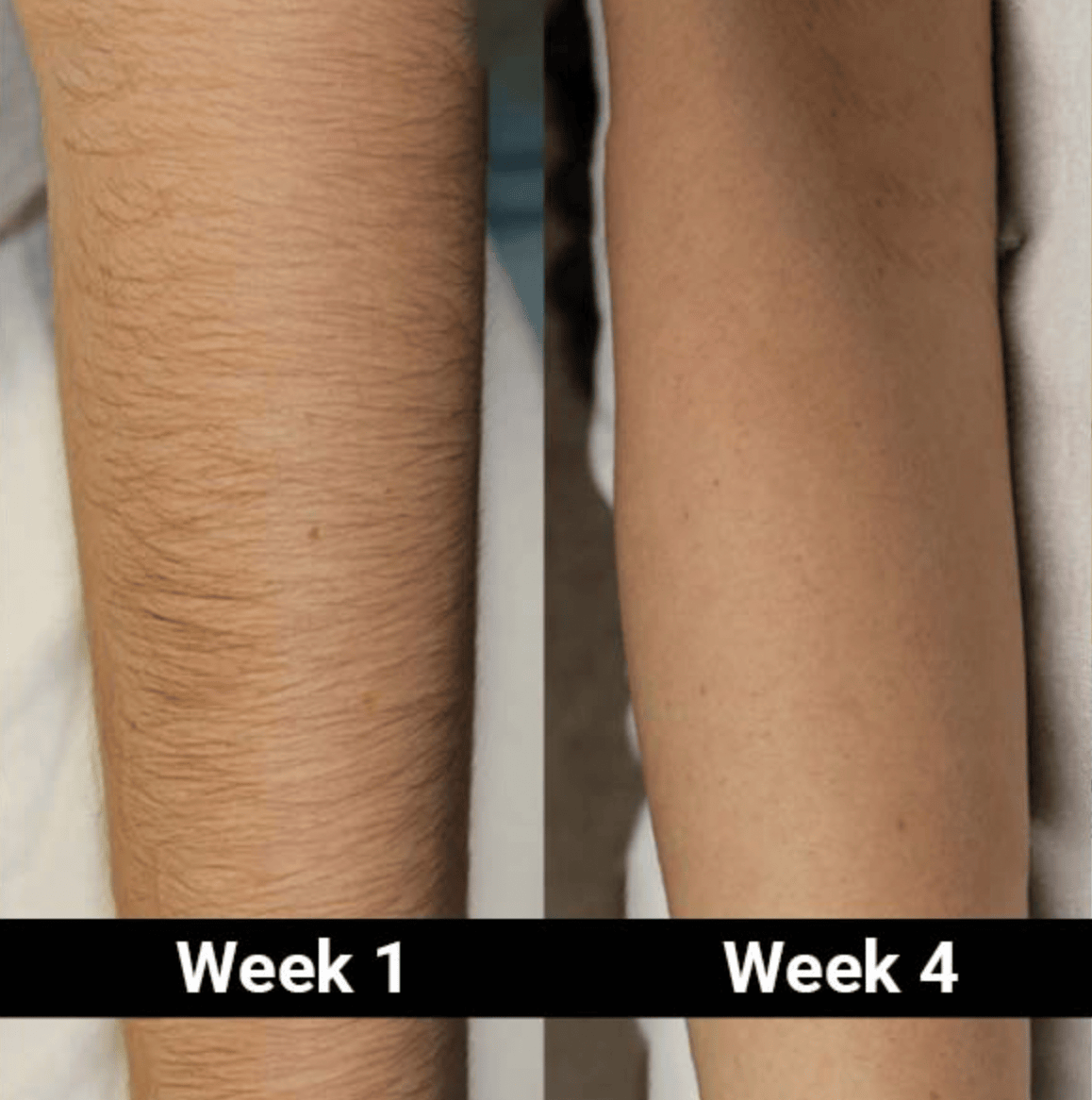 I Don’t Grow Body Hair Anymore After My Esthetician Showed Me This $169 ...